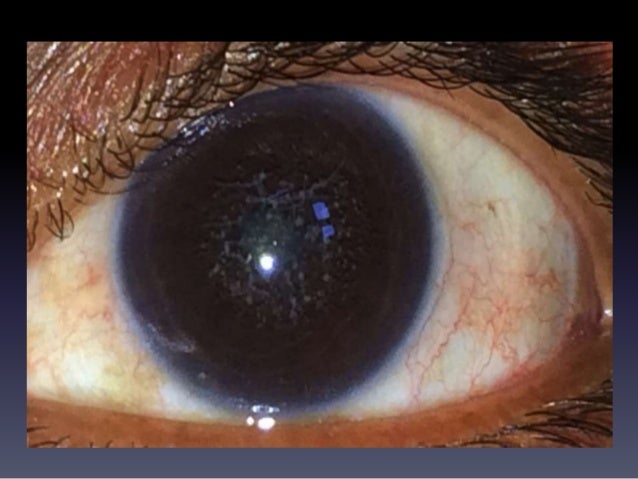 CASE PRESENTATION:Corneal stromal dystrophy