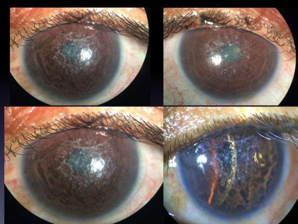 CASE PRESENTATION:Corneal stromal dystrophy