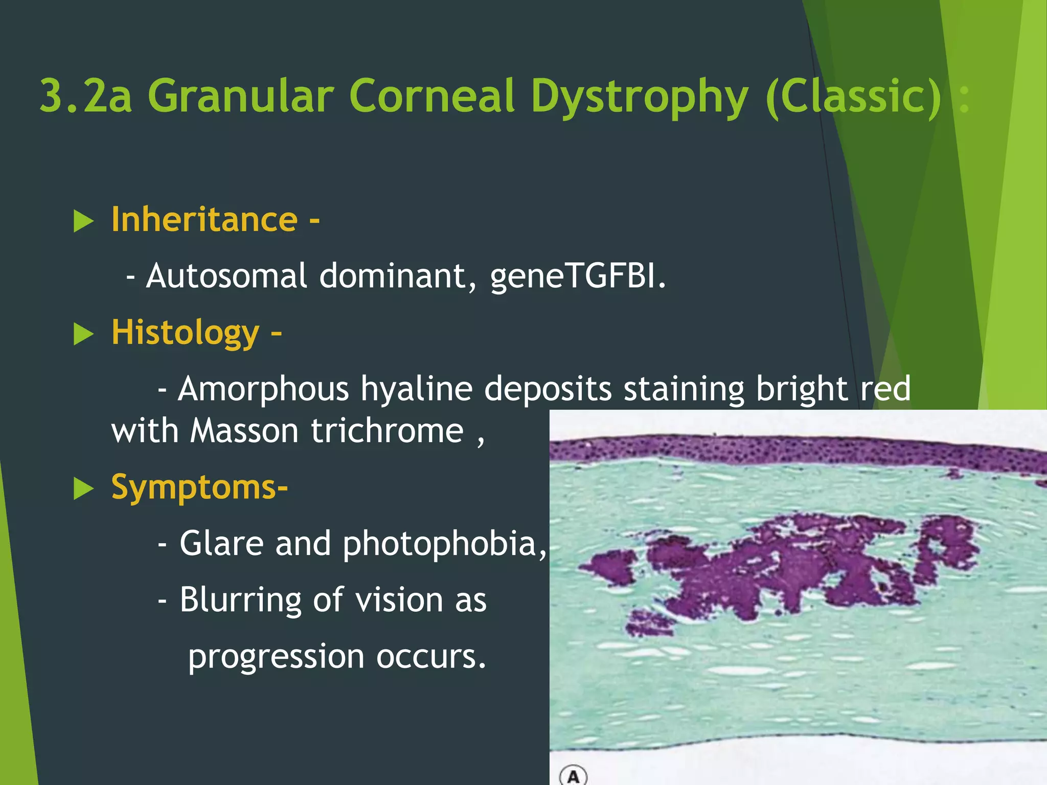Corneal Dystrophy By Dr Adnan Pptx
