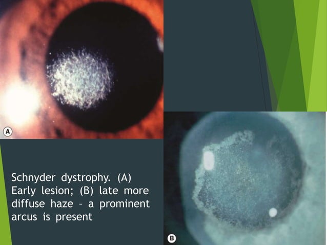 Corneal dystrophy by_dr.adnan | PPT