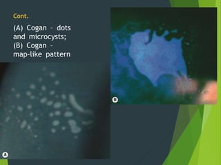 Corneal dystrophy by_dr.adnan | PPT