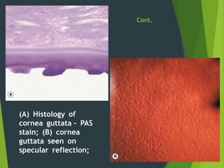 Corneal dystrophy by_dr.adnan | PPT