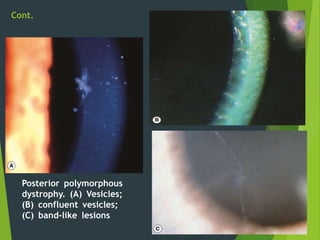 Corneal dystrophy by_dr.adnan | PPT