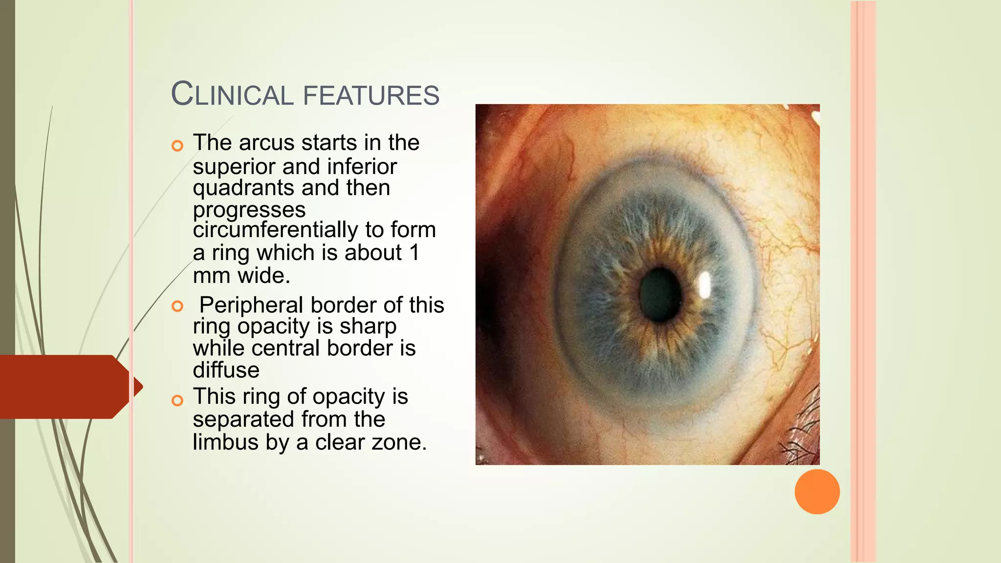 CORNEAL DYSTROPHY and degen.pptx | Eye and Vision Conditions | Diseases ...
