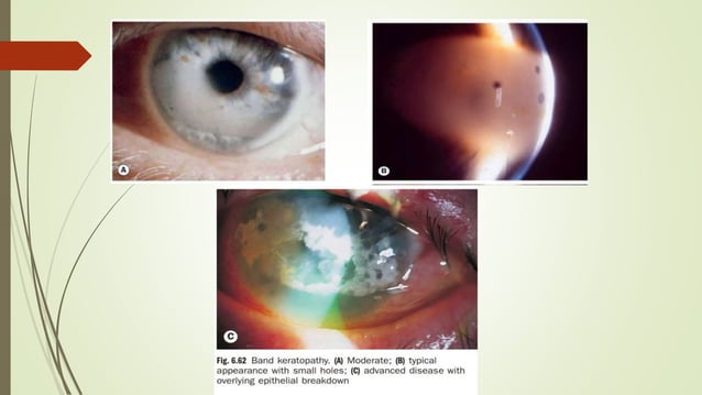 CORNEAL DYSTROPHY and degen.pptx
