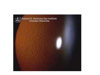 Corneal Guttata Retroillumination