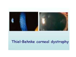 Thiel Behnke Dystrophy