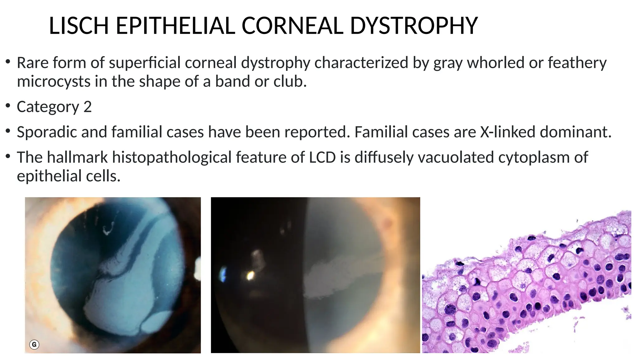 CORNEAL DYSTROPHY, DEGENERATION and treatment | PPTX
