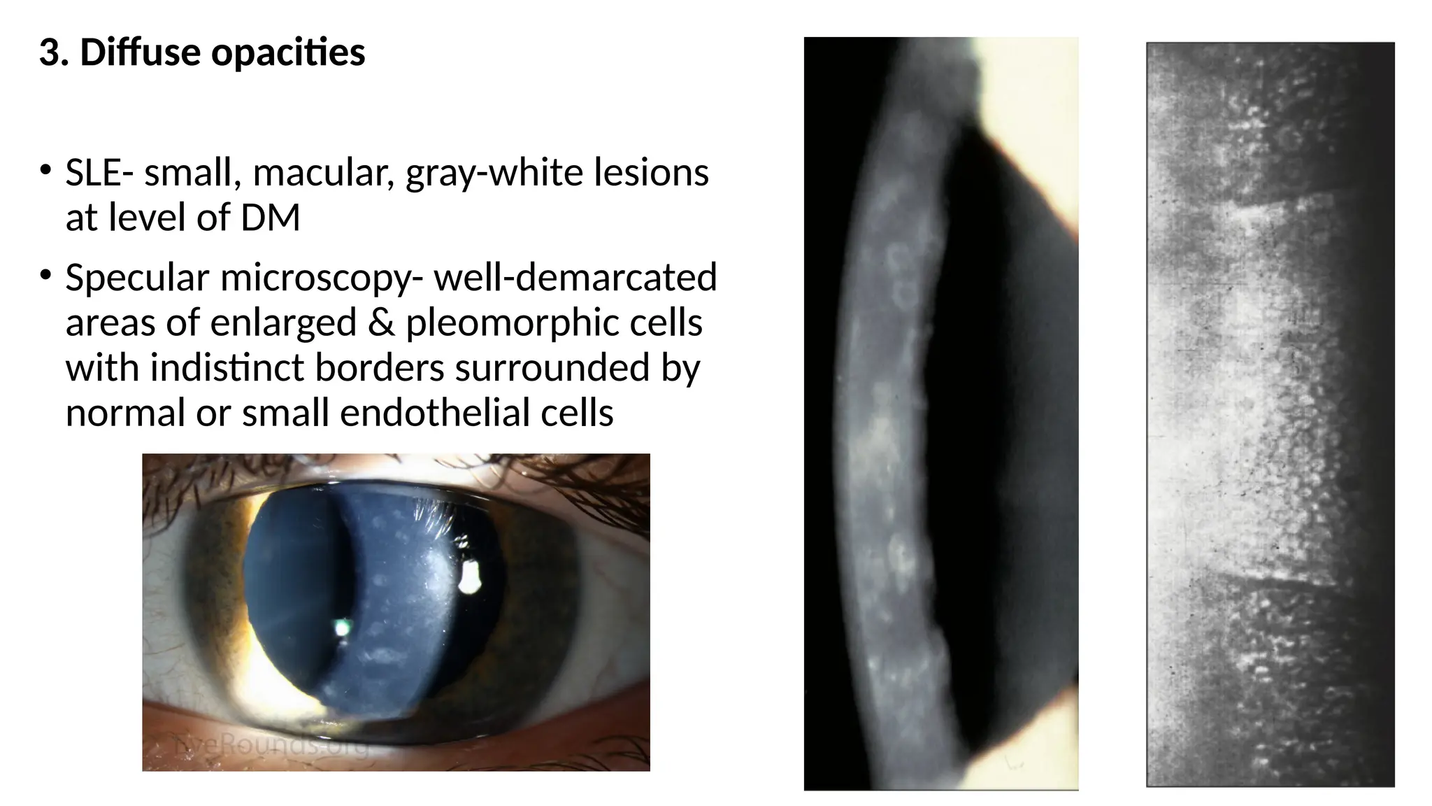CORNEAL DYSTROPHY, DEGENERATION and treatment | PPTX