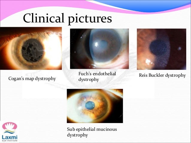 Corneal dystrophy