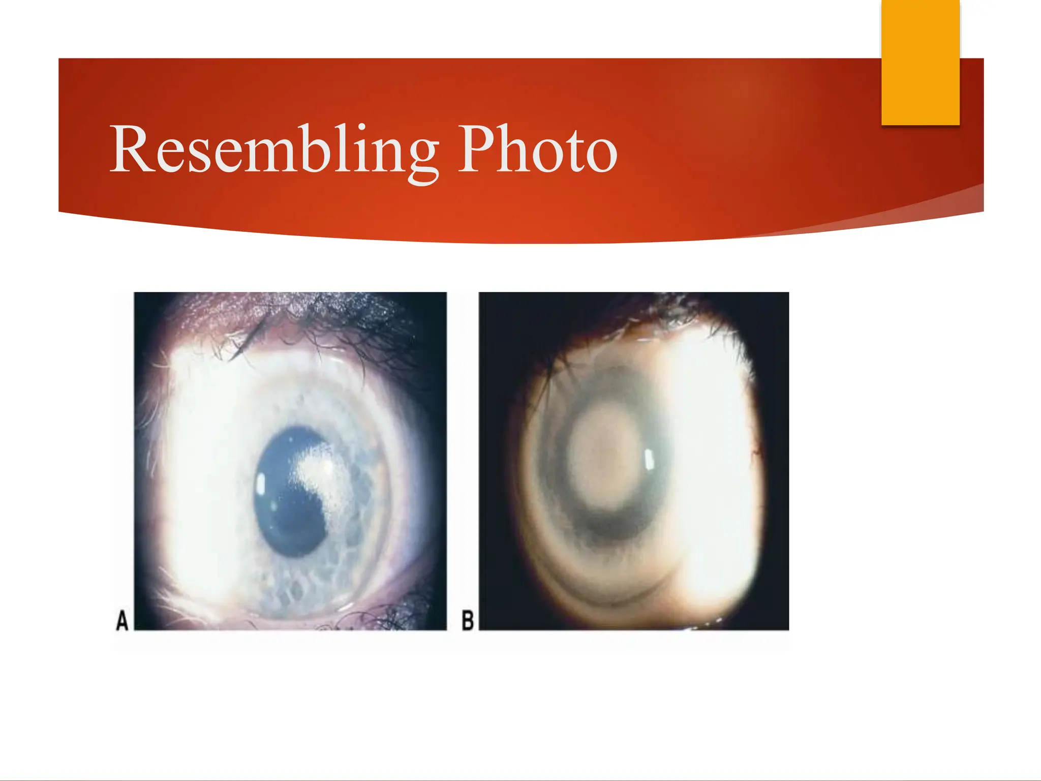 corneal dystrophy and corneal disorders (1).pptx