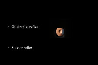 Corneal ectasias | PPT