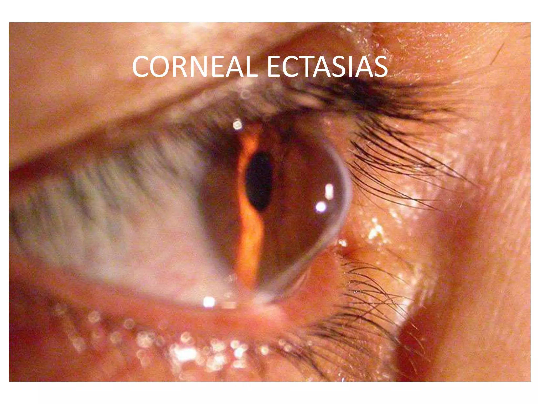Corneal ectasias | PPTX