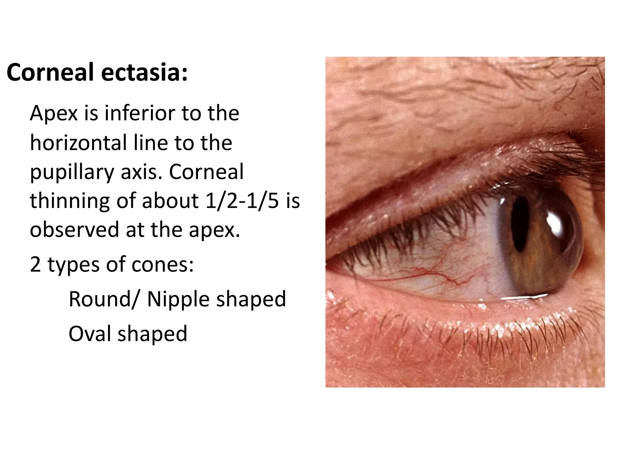 Corneal ectasias | PPTX