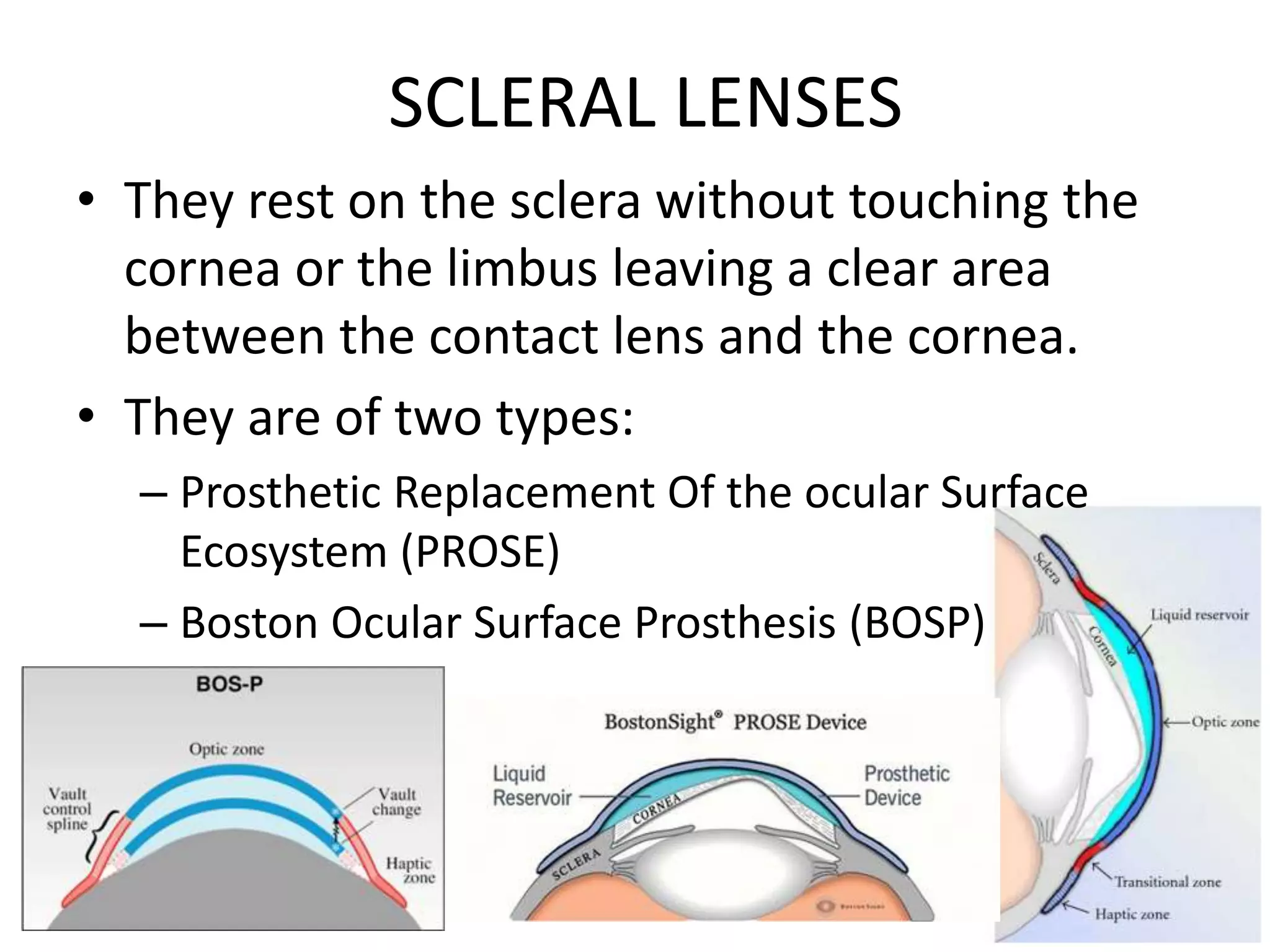 Corneal ectasias | PPTX