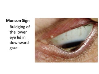 Corneal ectasias | PPTX