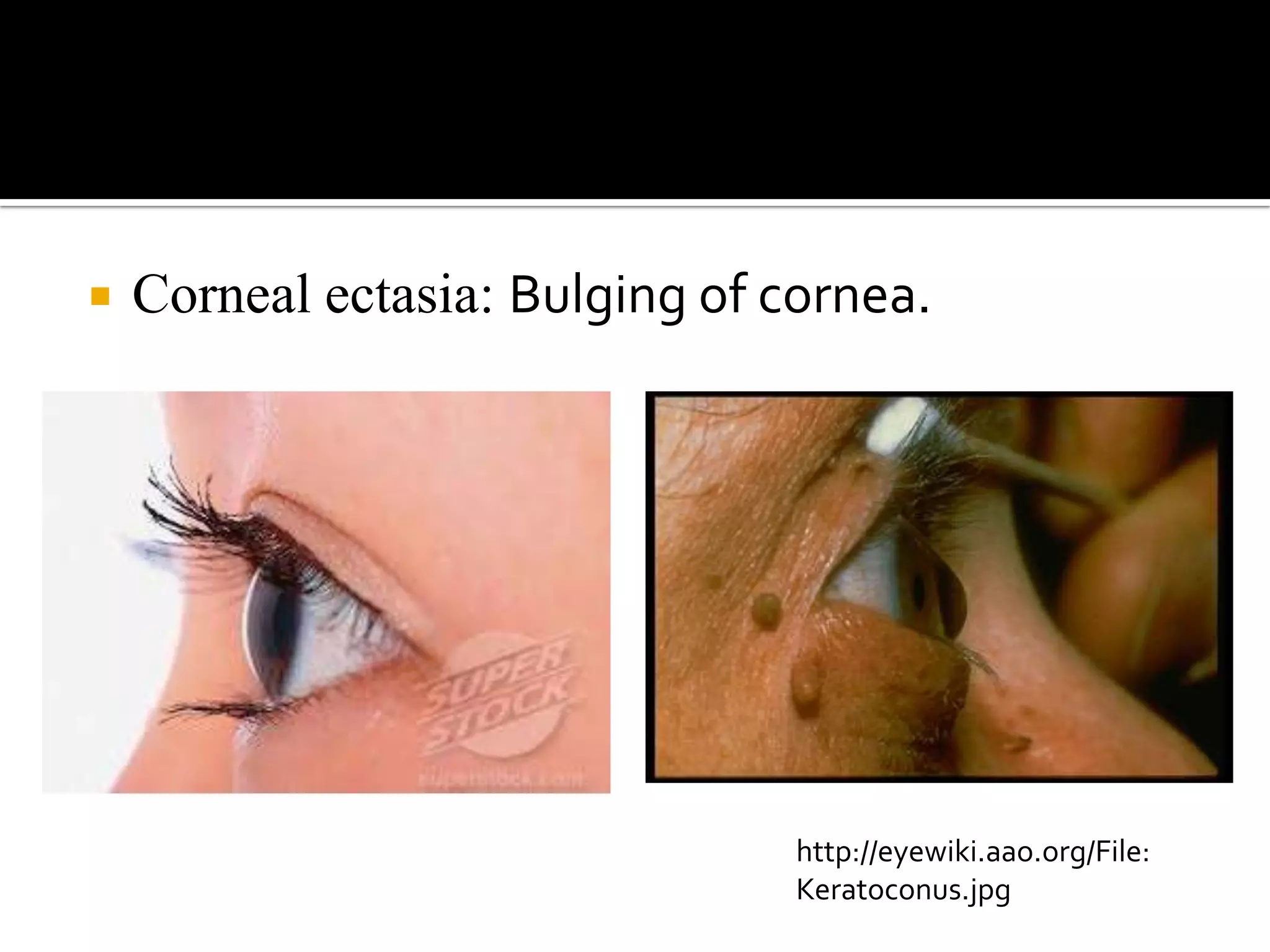 Corneal Ectasias | PPTX