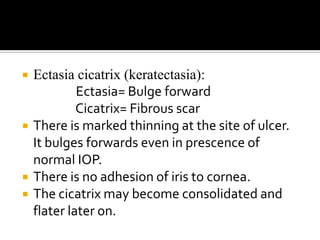 Corneal Ectasias | PPTX