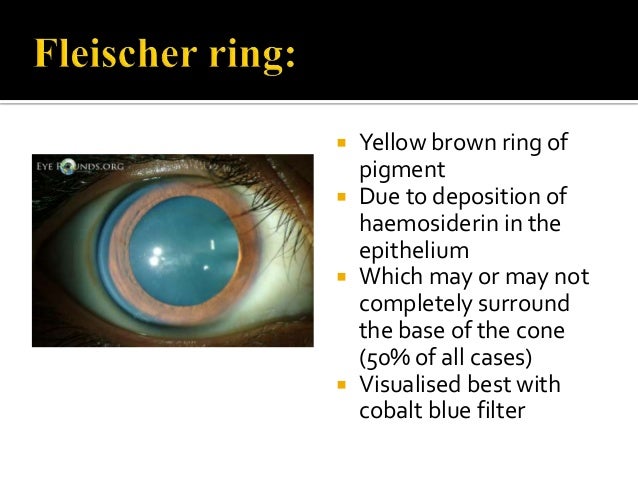 Corneal Ectasias
