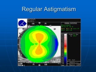 Cornea Topography | PPSX