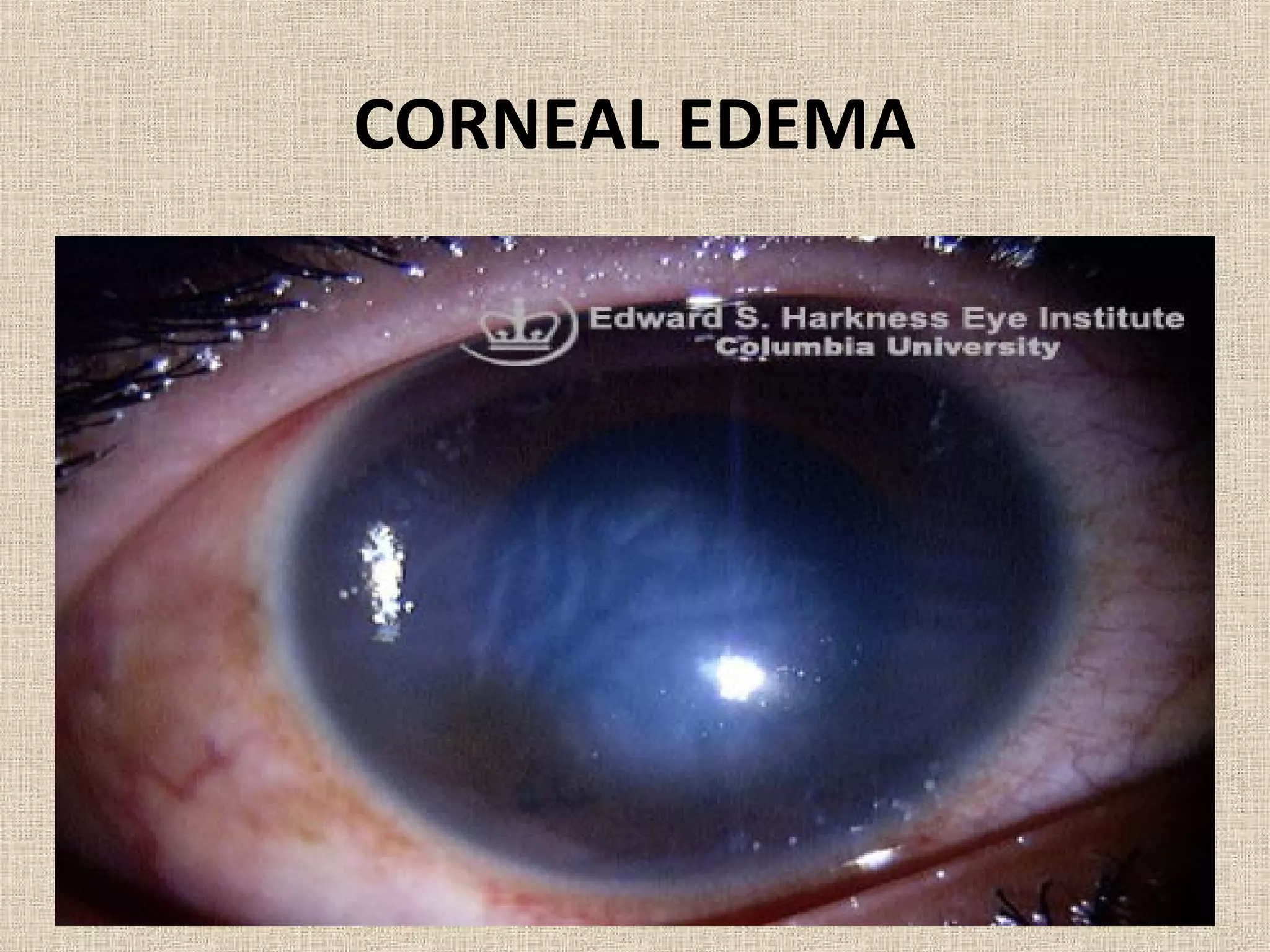 Corneal edema | PPT