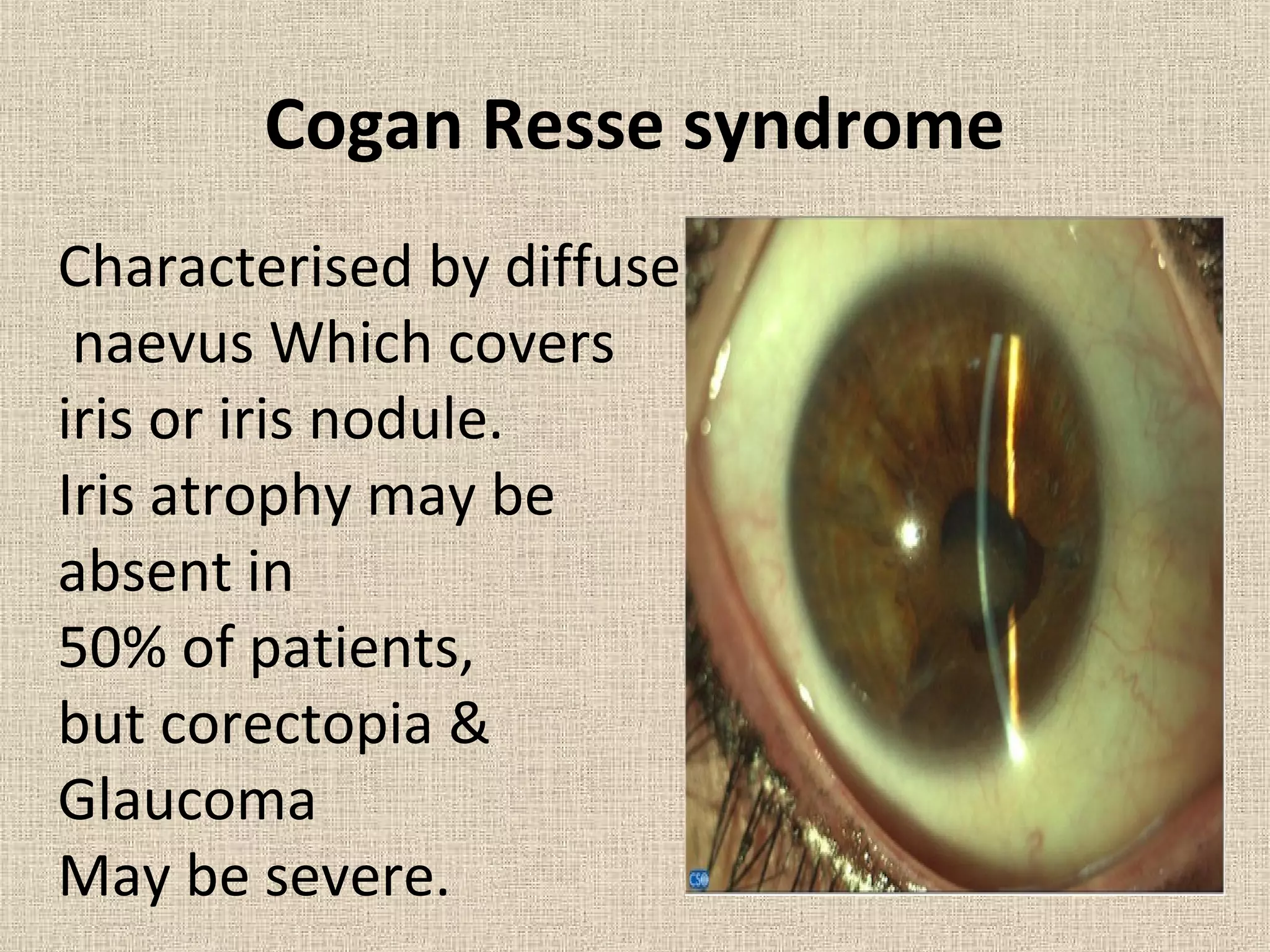 Corneal edema | PPT