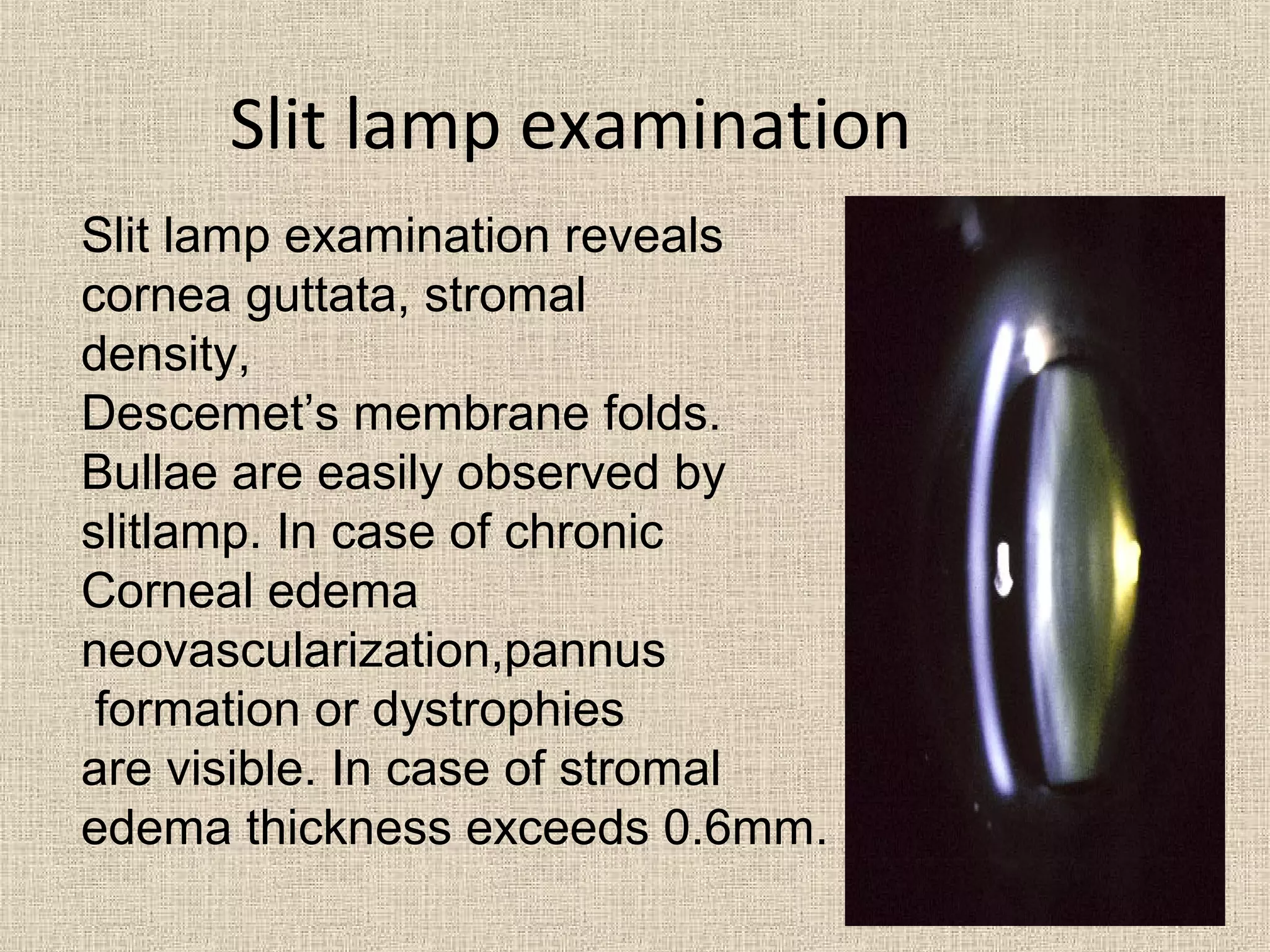 Corneal edema | PPT