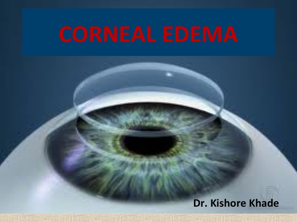 Corneal edema
