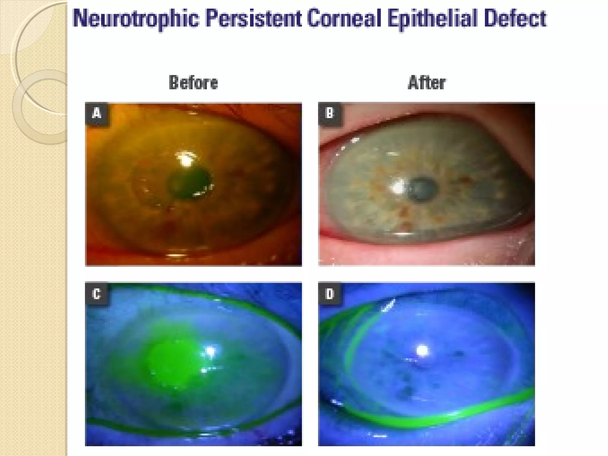 Corneal edema | PPT