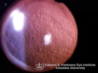 Corneal Guttata Retroillumination