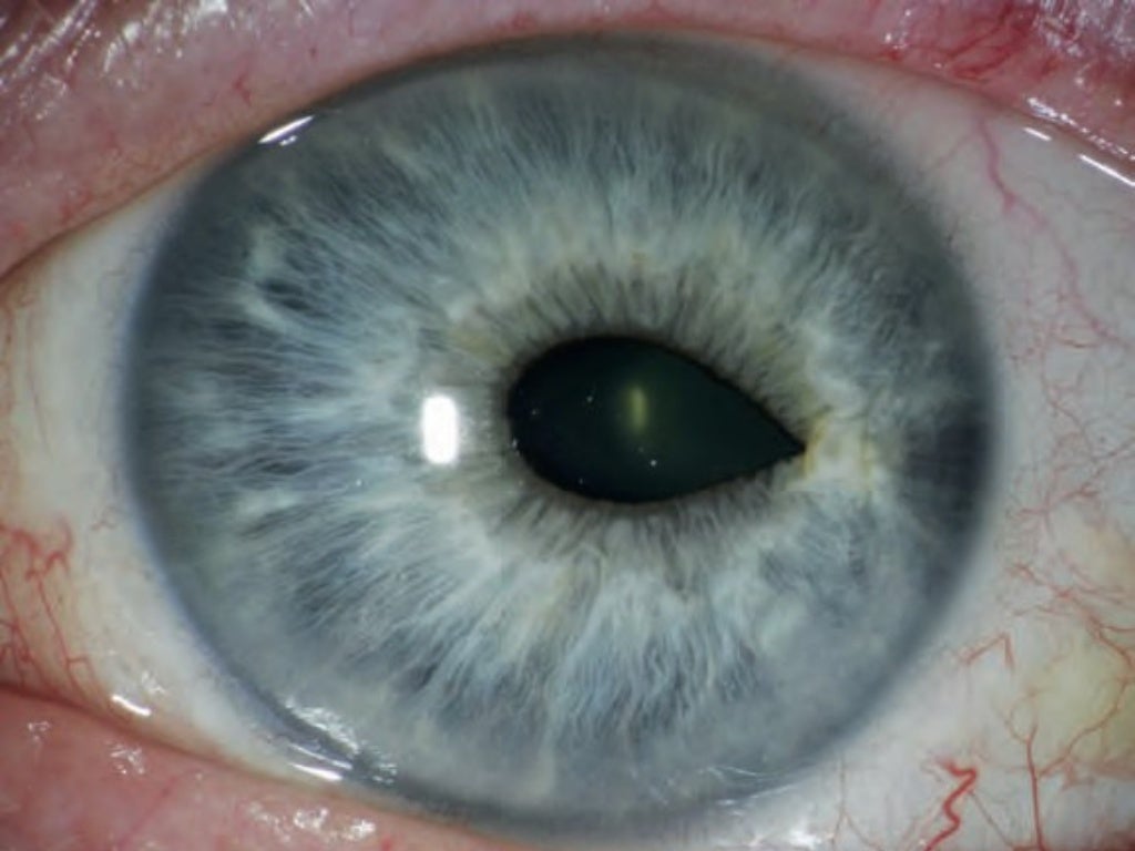 Corneal edema