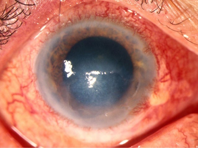 Corneal edema
