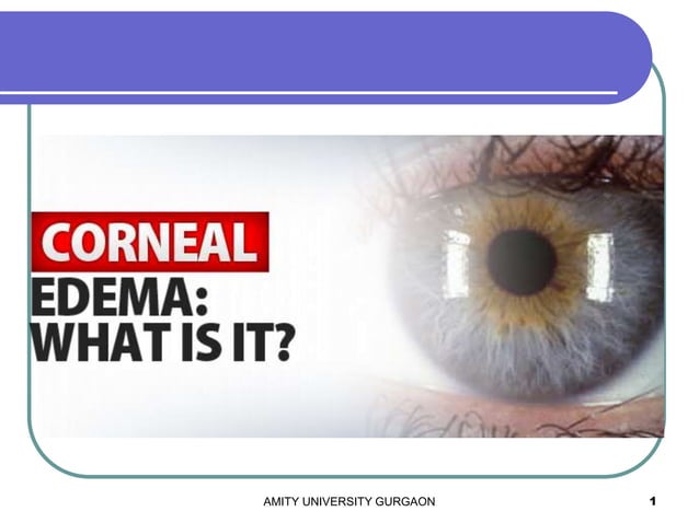 Corneal edema | PPTX | Eye and Vision Conditions | Diseases and Conditions