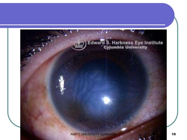 Corneal edema | PPTX | Eye and Vision Conditions | Diseases and Conditions