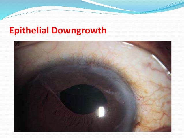 Epithelial Downgrowth Check Out Our New Section Called Illustrations
