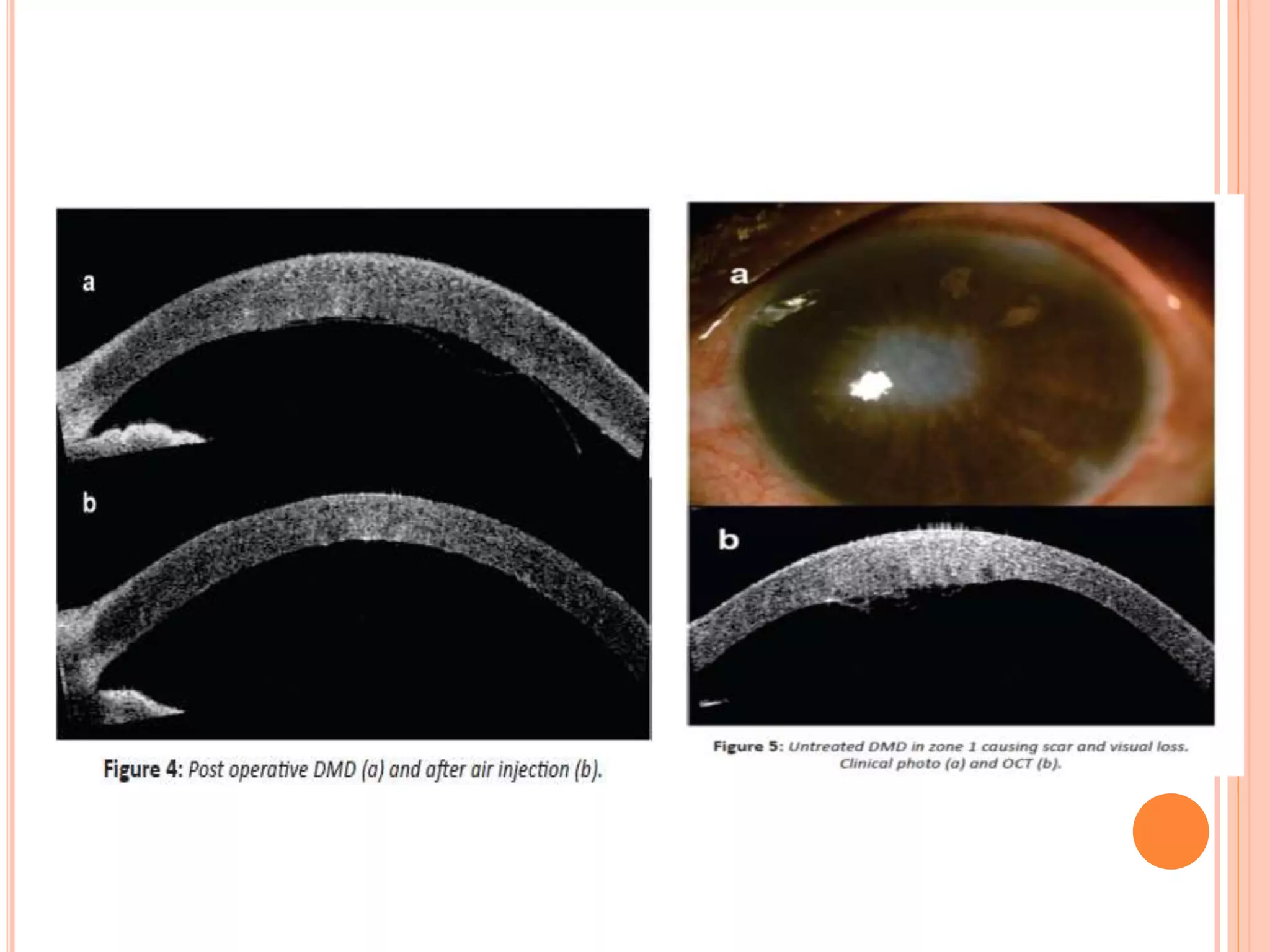 Corneal edema after cataract surgery | PPTX | Eye and Vision Conditions ...