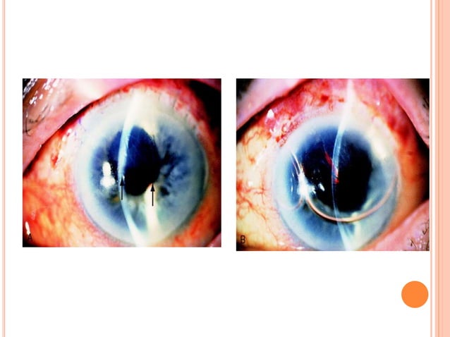 Corneal edema after cataract surgery