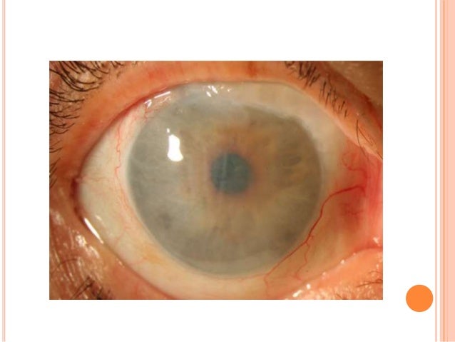 Corneal edema after cataract surgery