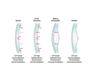 Corneal edema numbers | PPTX