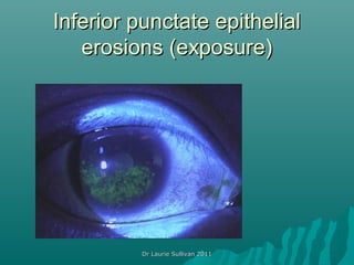 Punctate Epithelial Erosions