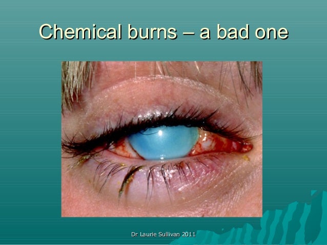 Corneal emergencies
