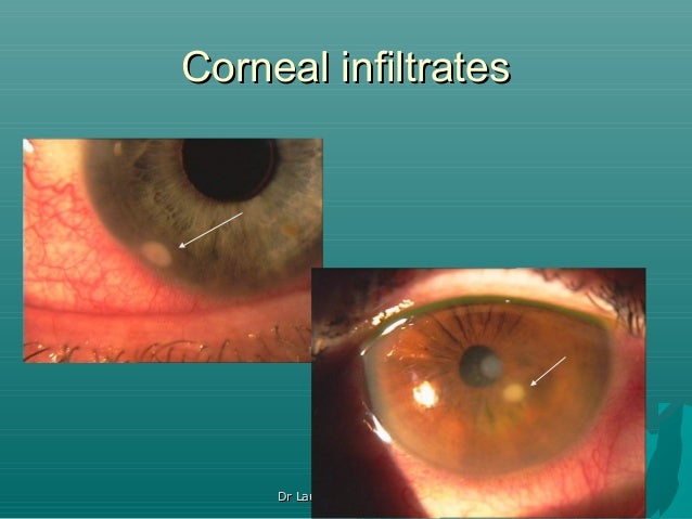 Corneal emergencies
