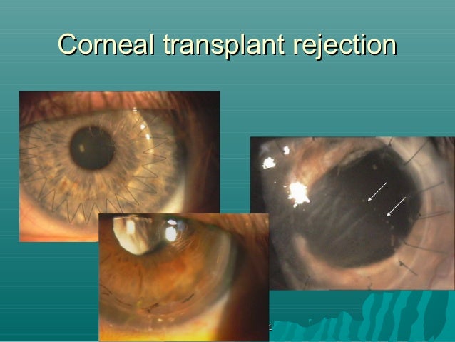 Corneal Transplant Rejection Treatment