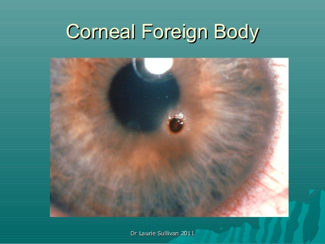 Corneal Foreign Body
