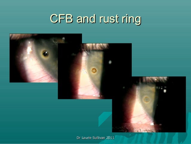 Corneal Rust Ring