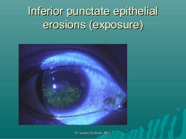 Corneal emergencies