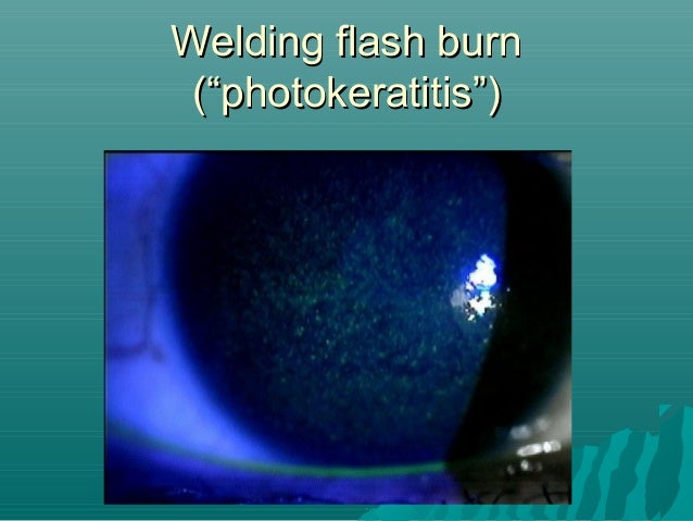 Corneal emergencies