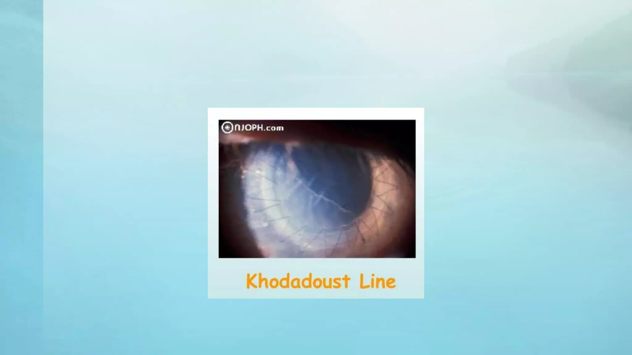 Corneal graft rejection | PPTX