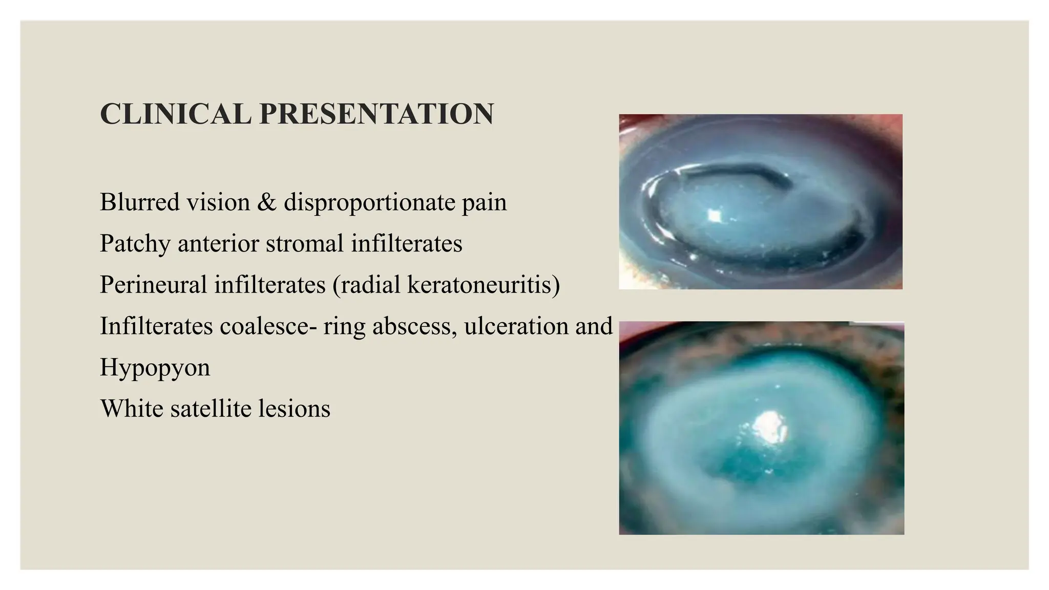 corneal infection.pptx types causes management | PPTX