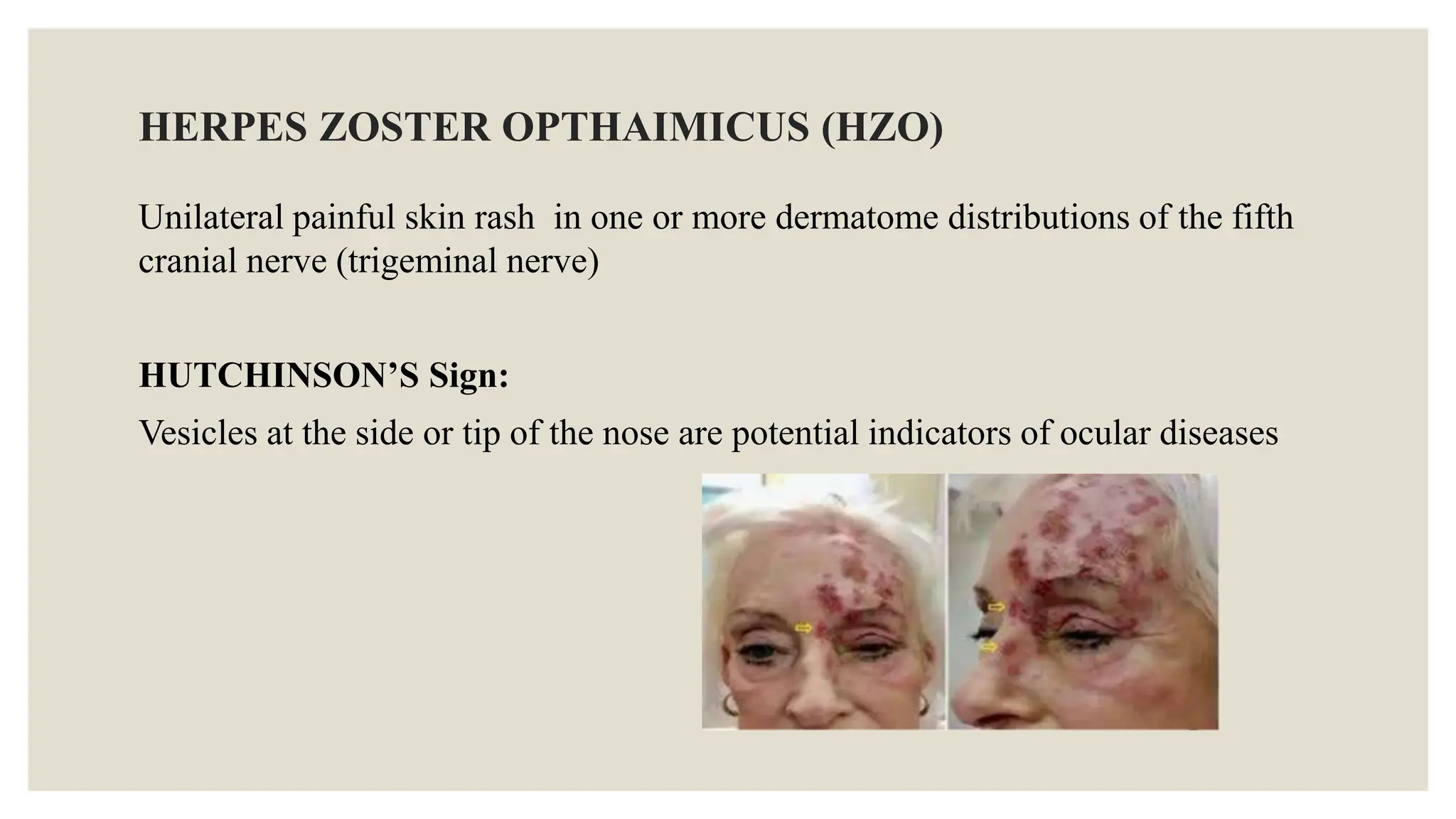 corneal infection.pptx types causes management | PPTX
